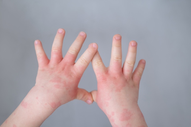 Children with obesity more likely to develop immune-related skin ...