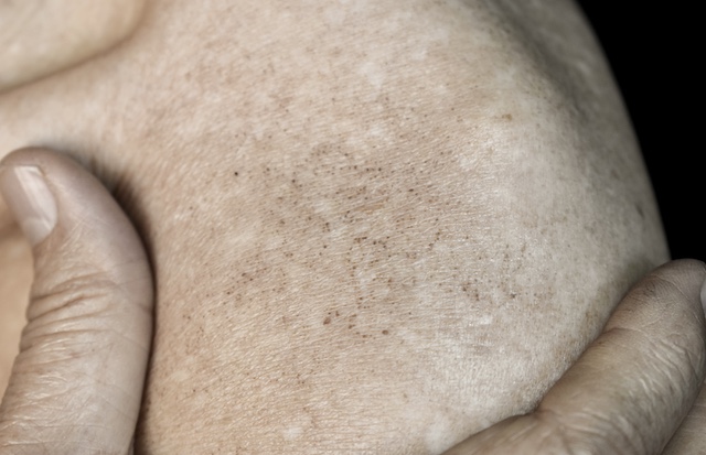 Semaglutide shows potential in managing chronic skin condition in ...